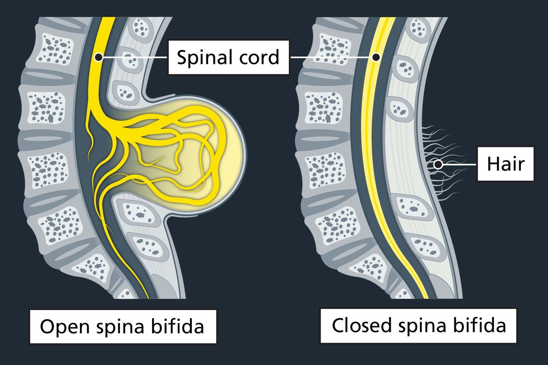 Spina bifida - NHS