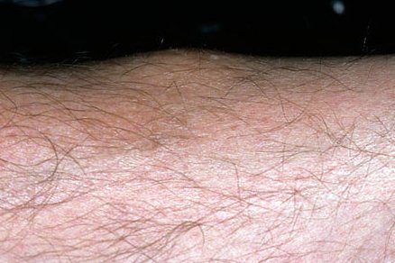Erythema nodosum - NHS
