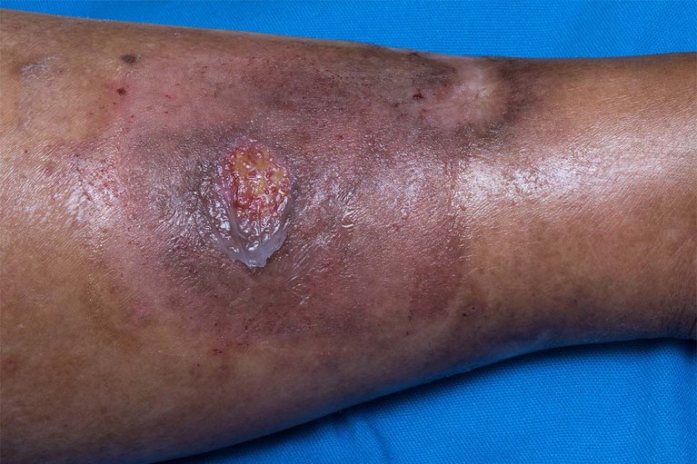 Pyoderma gangrenosum - NHS
