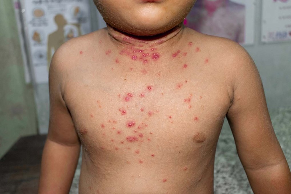 Molluscum contagiosum - NHS