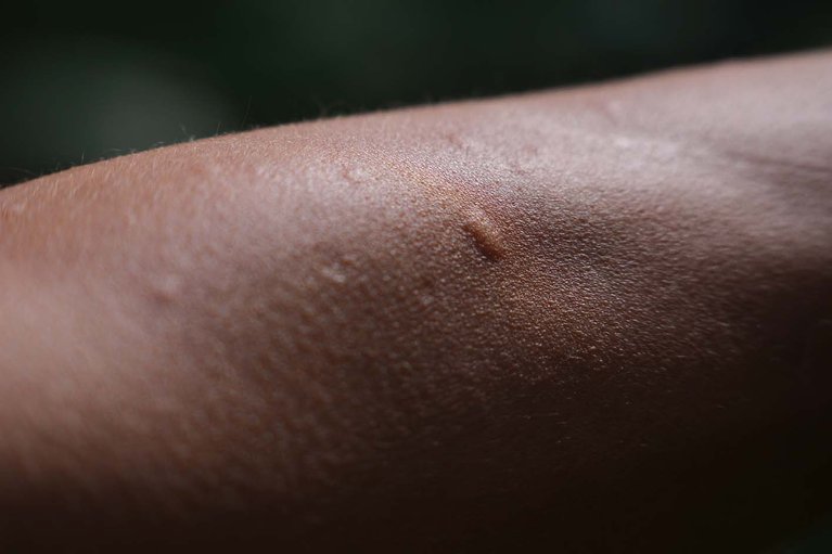 Insect bites and stings - NHS