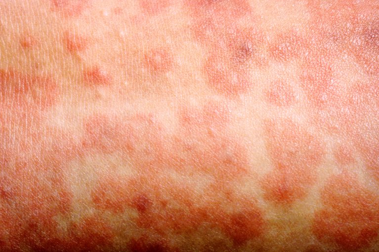 Measles - Symptoms - NHS