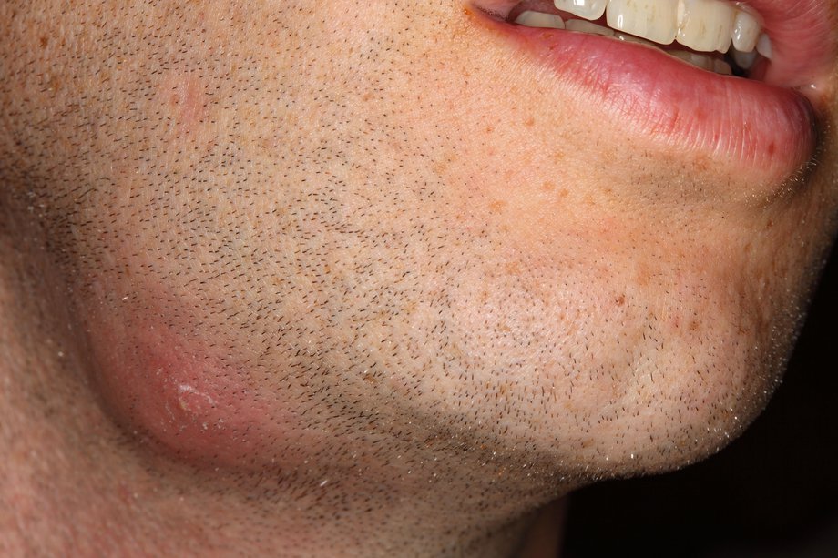 What Is Abscess Infection Symptoms Of An Abscess How To Prevent A What Is Abscess Infection Symptoms Of An Abscess How To Prevent A