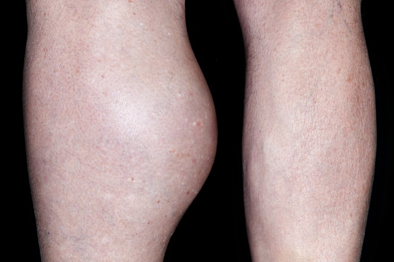 Baker s Cyst EM Doctors