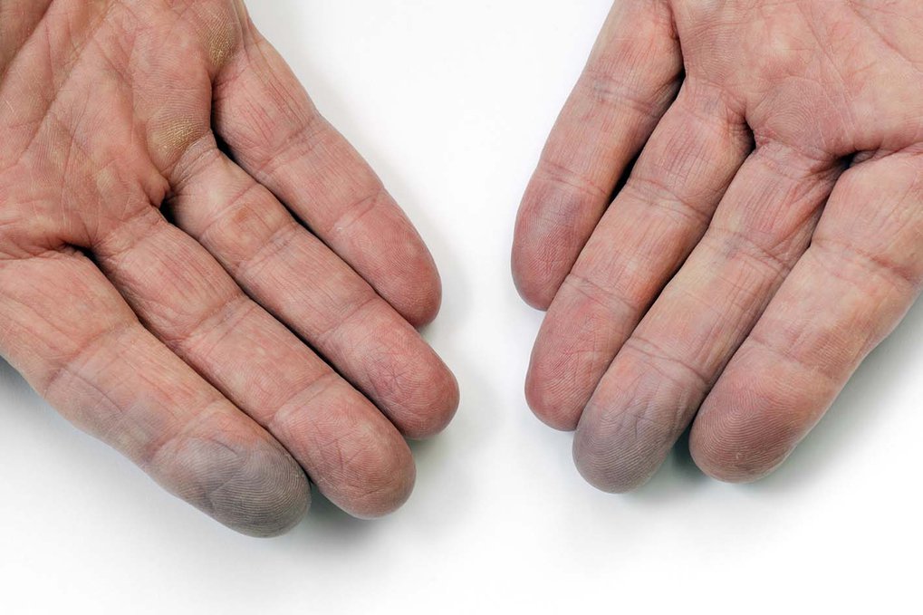 Raynaud’s phenomenon – what are the signs and symptoms? | Patient Talk