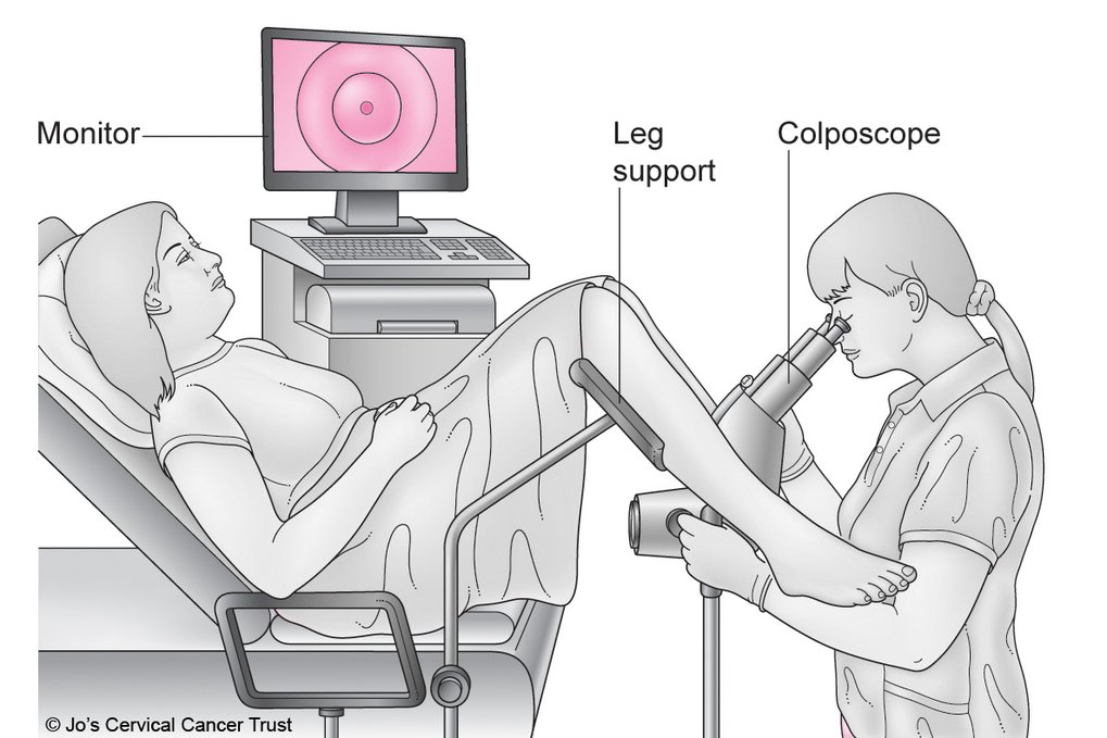 Colposcopy - EM Doctors