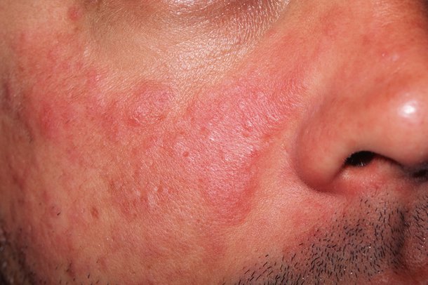 Early Signs Of Lupus Rash