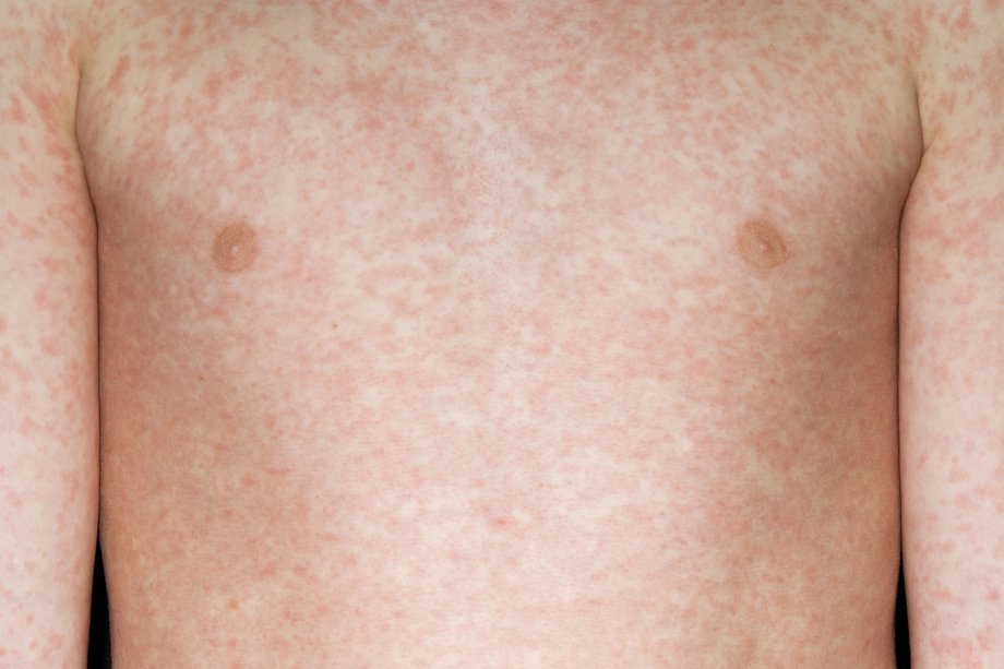 Skin Rashes In Children NHS UK Skin Rashes In Children NHS UK