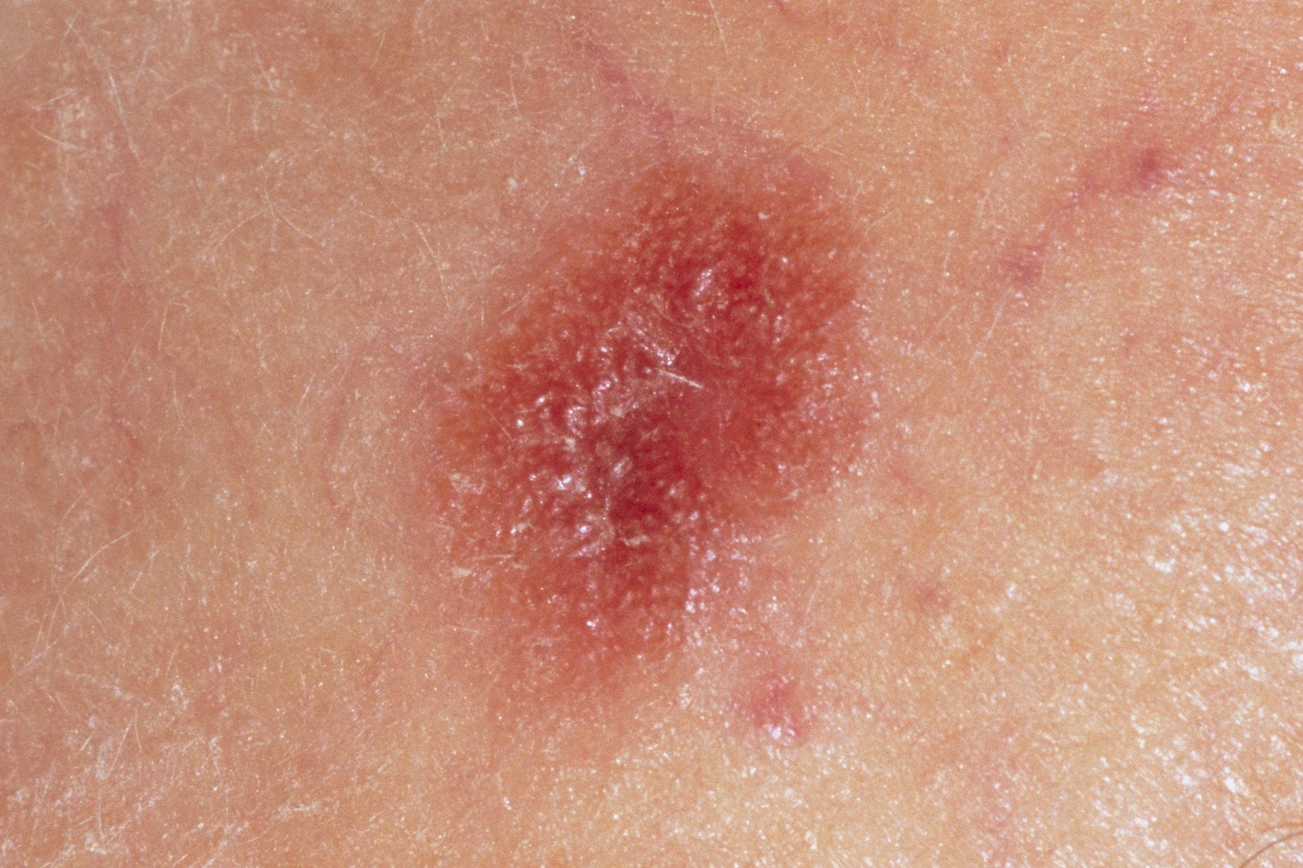 The Health Hub: Skin cancer (melanoma) - Overview