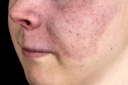 Birthmarks | Wetenschap
