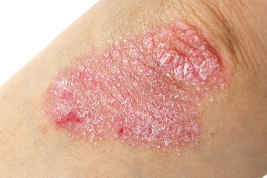 Skin Lesions NHS Skin Lesions NHS