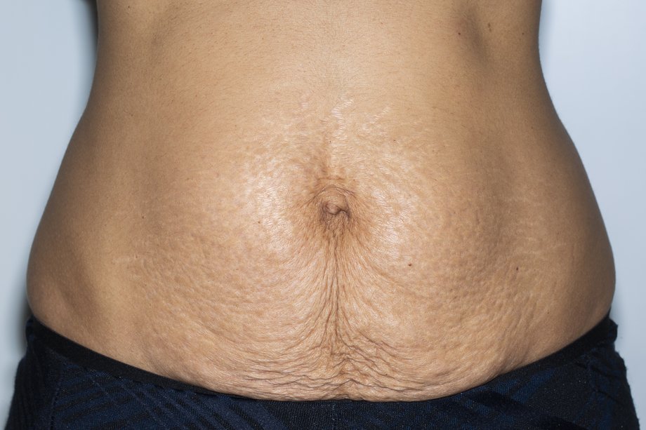 How To Get Rid Of Line On Stomach After Pregnancy PregnancyWalls